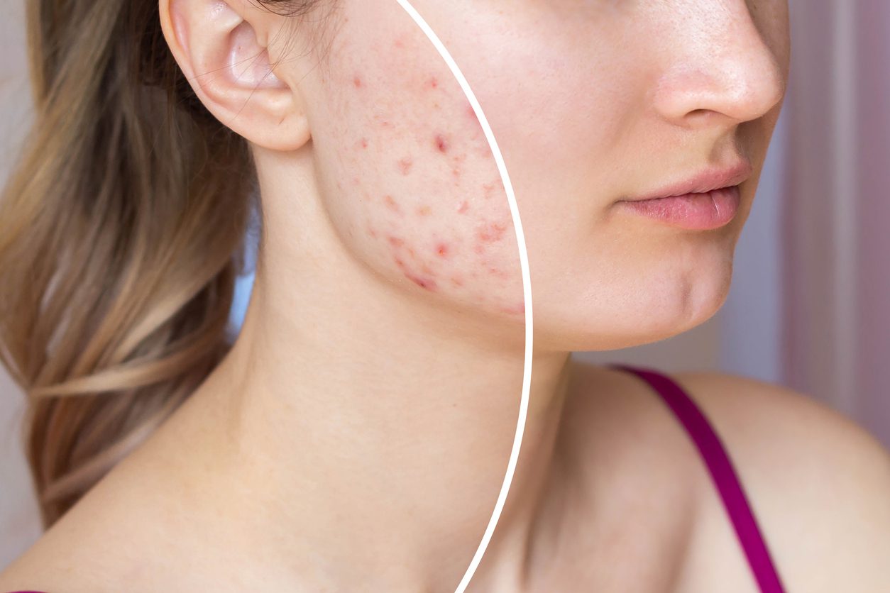 Understanding Acne: Causes, Types, and Effective Treatments